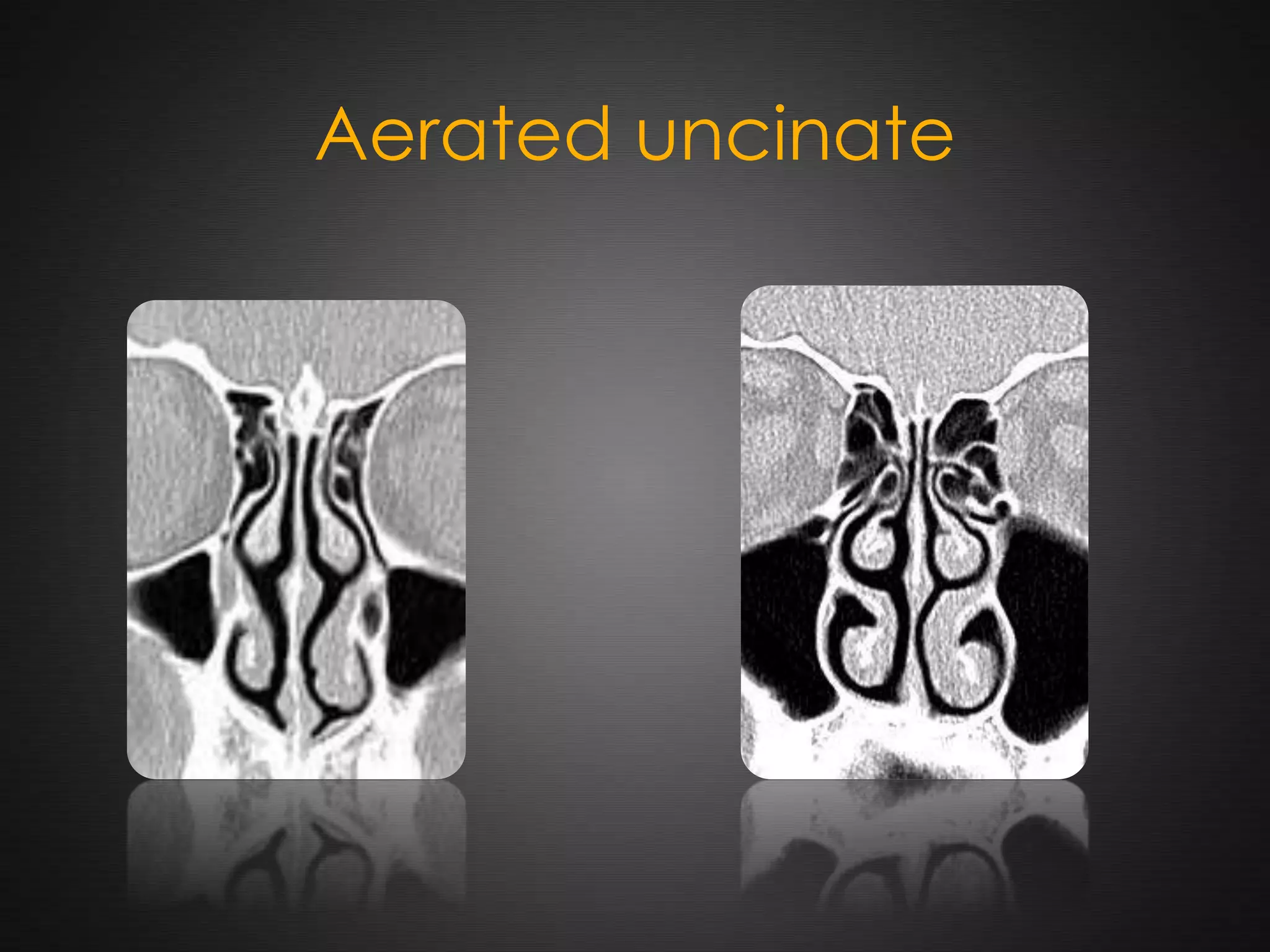 ANATOMICAL VARIANTS OF CT PNS | PPTX