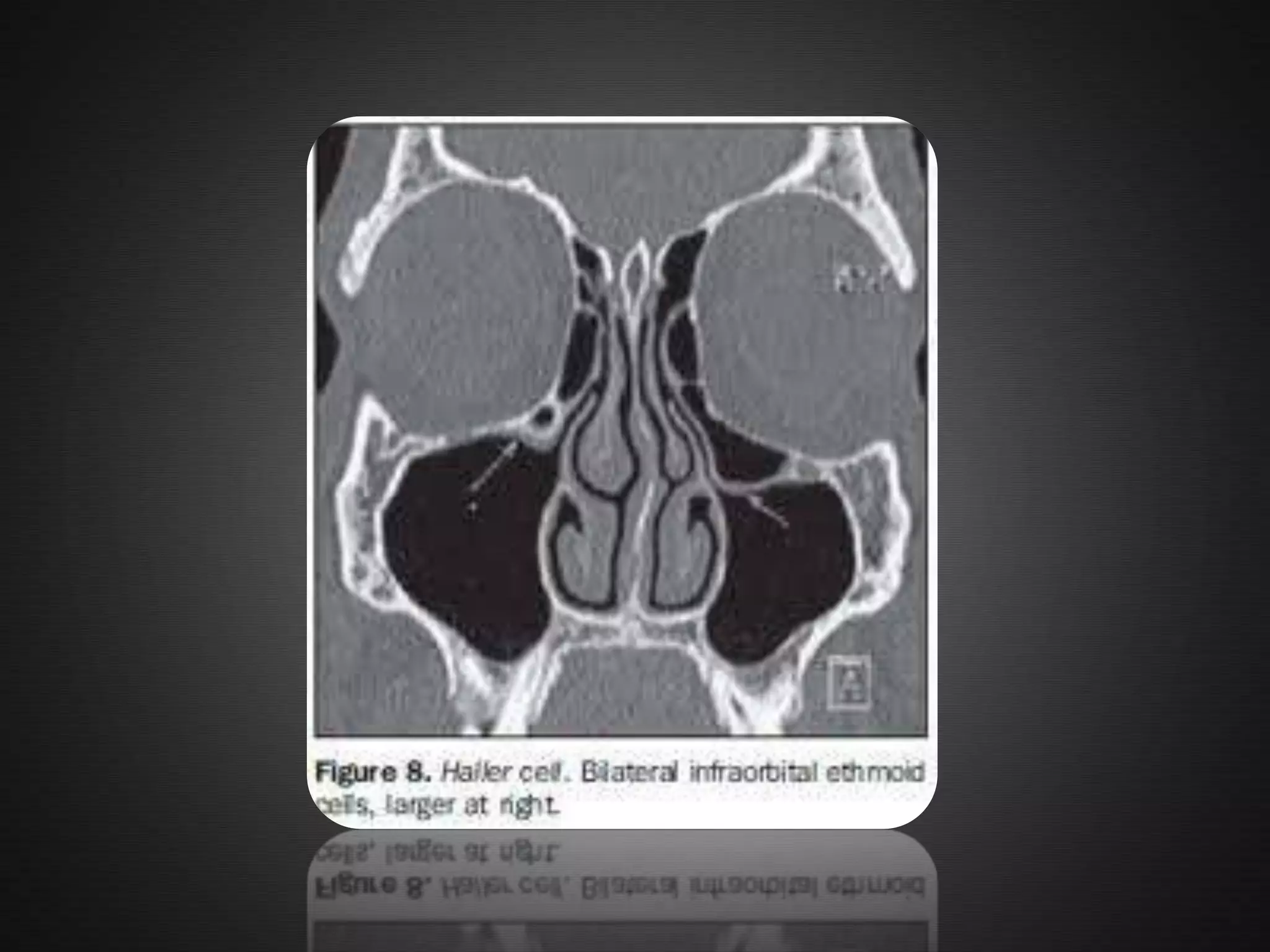 ANATOMICAL VARIANTS OF CT PNS | PPTX