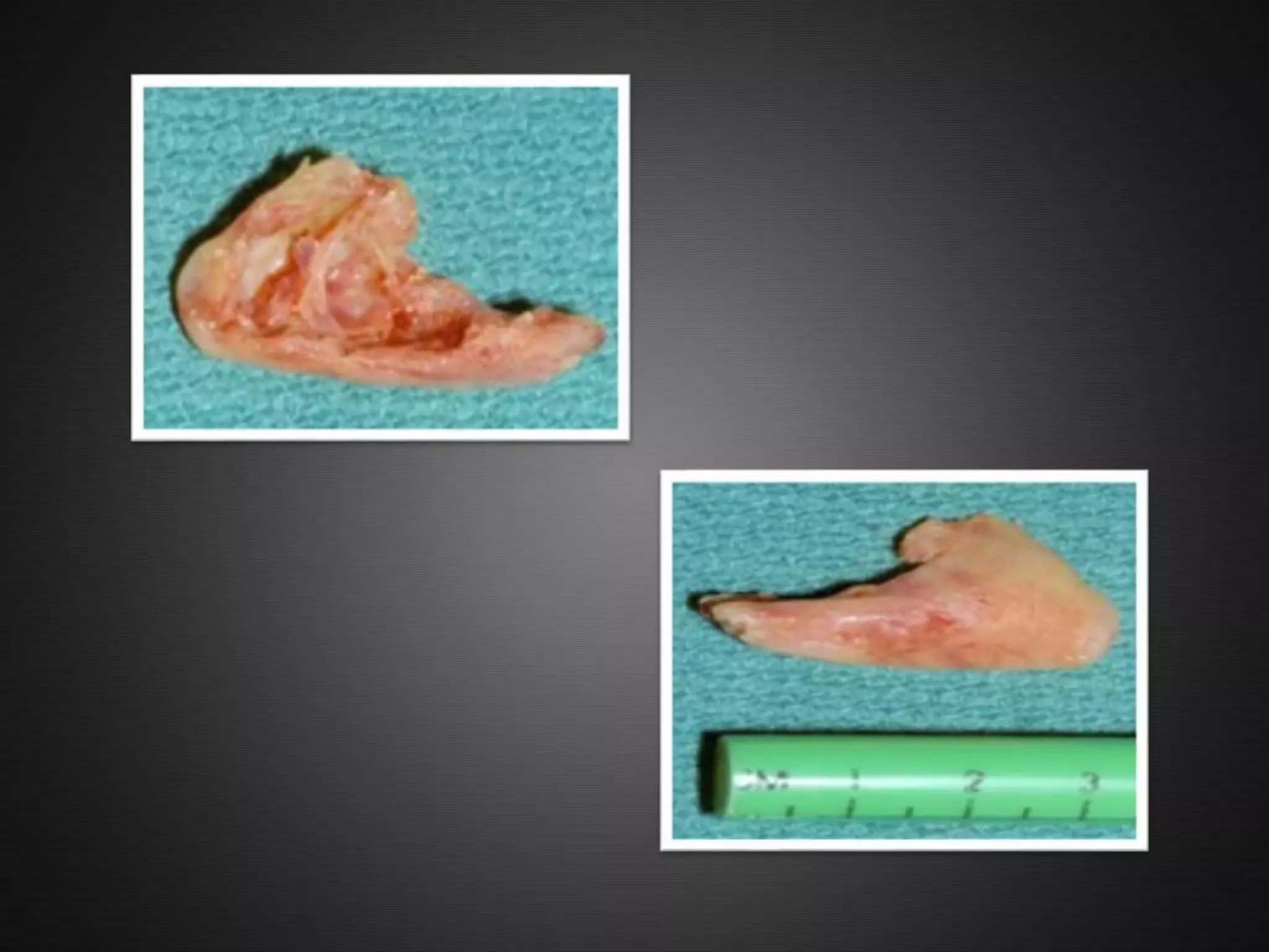 ANATOMICAL VARIANTS OF CT PNS | PPTX