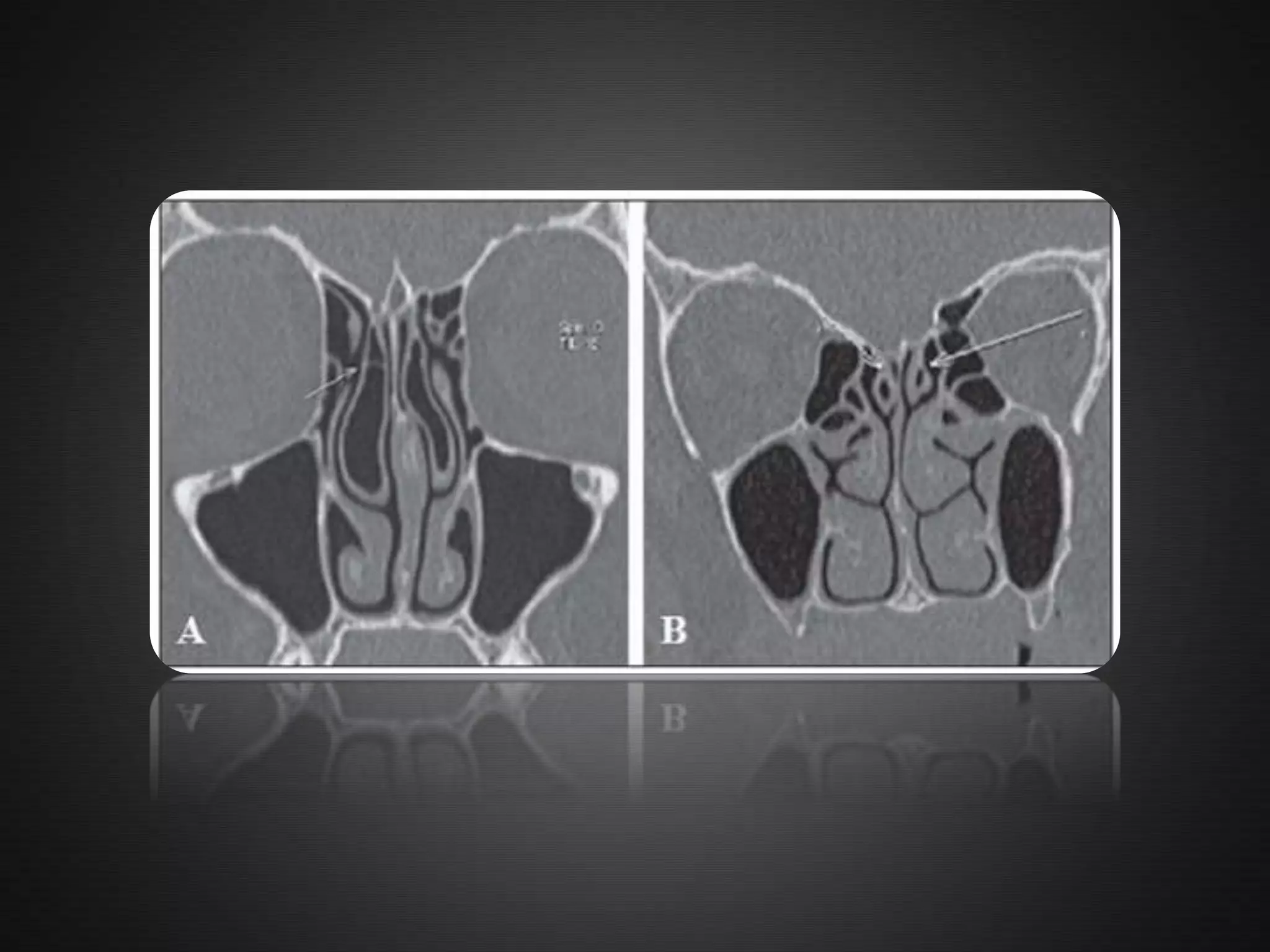 ANATOMICAL VARIANTS OF CT PNS | PPTX