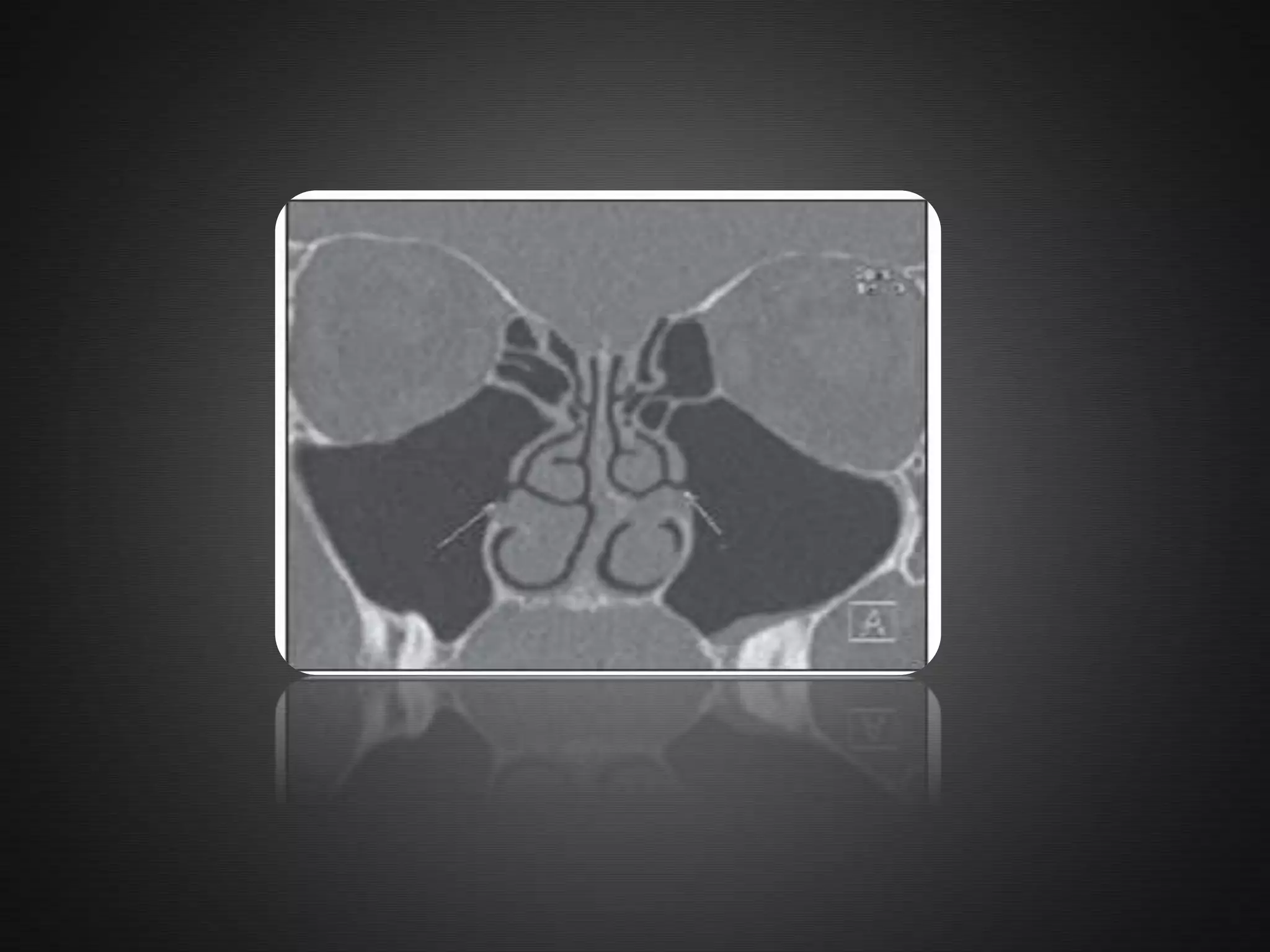 ANATOMICAL VARIANTS OF CT PNS | PPTX