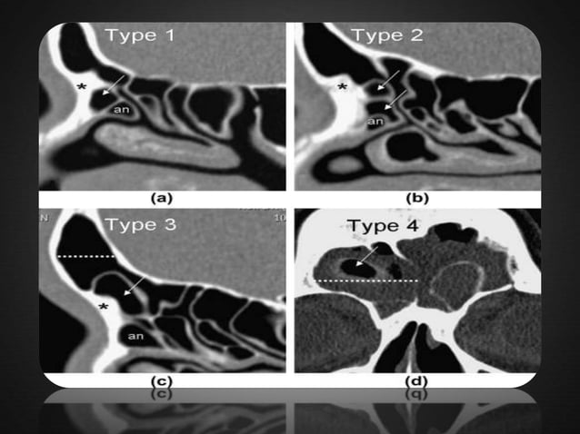 ANATOMICAL VARIANTS OF CT PNS | PPTX