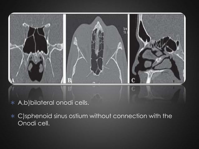 ANATOMICAL VARIANTS OF CT PNS | PPTX