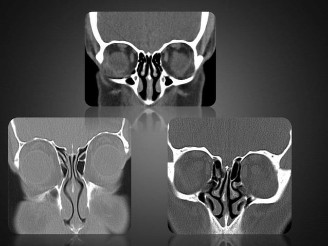 ANATOMICAL VARIANTS OF CT PNS | PPTX