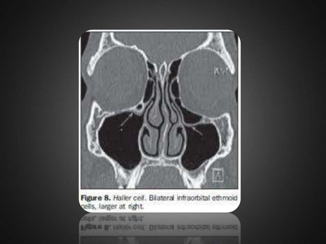 ANATOMICAL VARIANTS OF CT PNS | PPTX