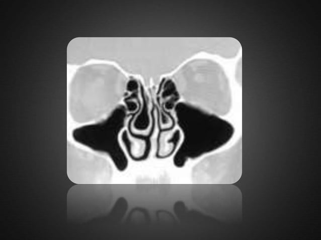 ANATOMICAL VARIANTS OF CT PNS | PPTX