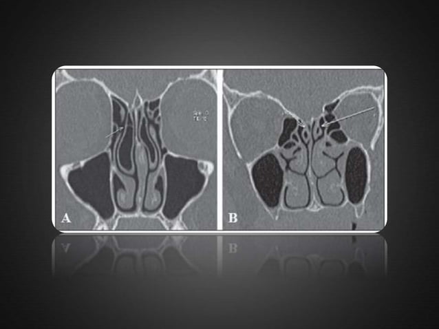 ANATOMICAL VARIANTS OF CT PNS | PPTX