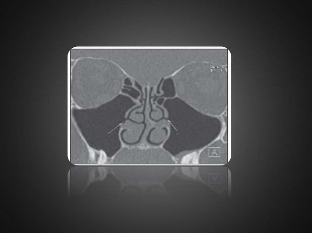 ANATOMICAL VARIANTS OF CT PNS | PPTX