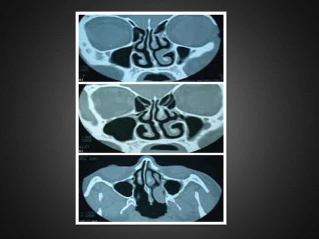 ANATOMICAL VARIANTS OF CT PNS | PPTX