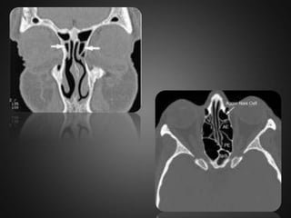 ANATOMICAL VARIANTS OF CT PNS | PPTX