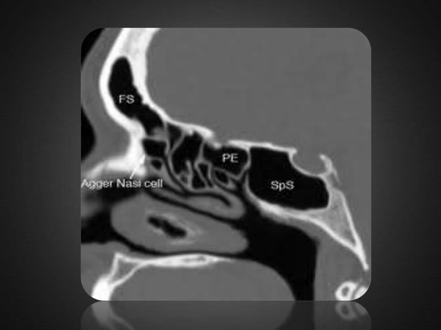 ANATOMICAL VARIANTS OF CT PNS | PPTX