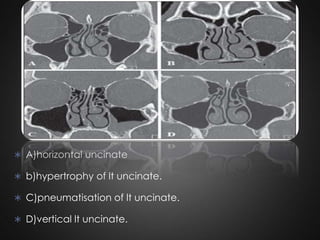 ANATOMICAL VARIANTS OF CT PNS | PPT