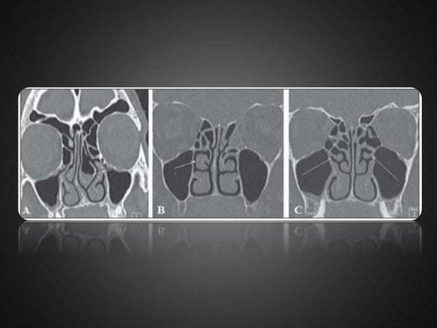 ANATOMICAL VARIANTS OF CT PNS