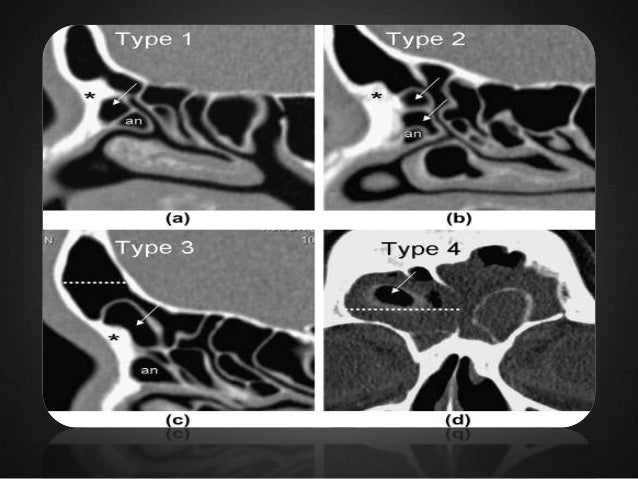 ANATOMICAL VARIANTS OF CT PNS