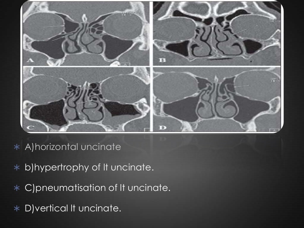 ANATOMICAL VARIANTS OF CT PNS