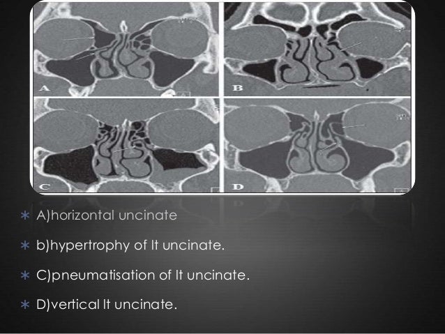 ANATOMICAL VARIANTS OF CT PNS