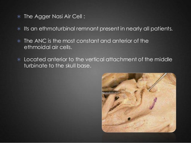 ANATOMICAL VARIANTS OF CT PNS