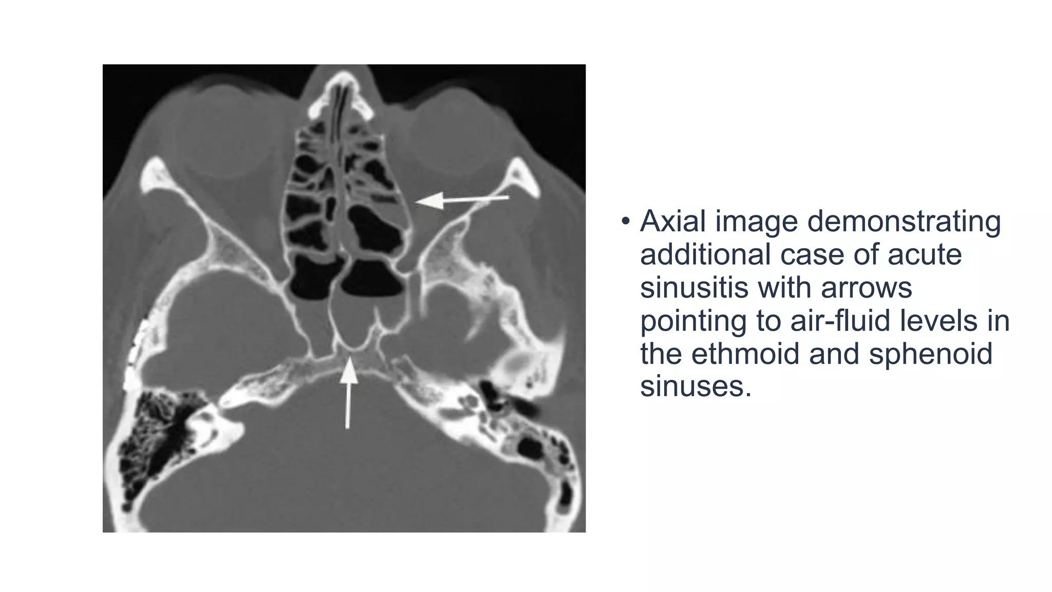 PNS INFLAMMATION.pptx