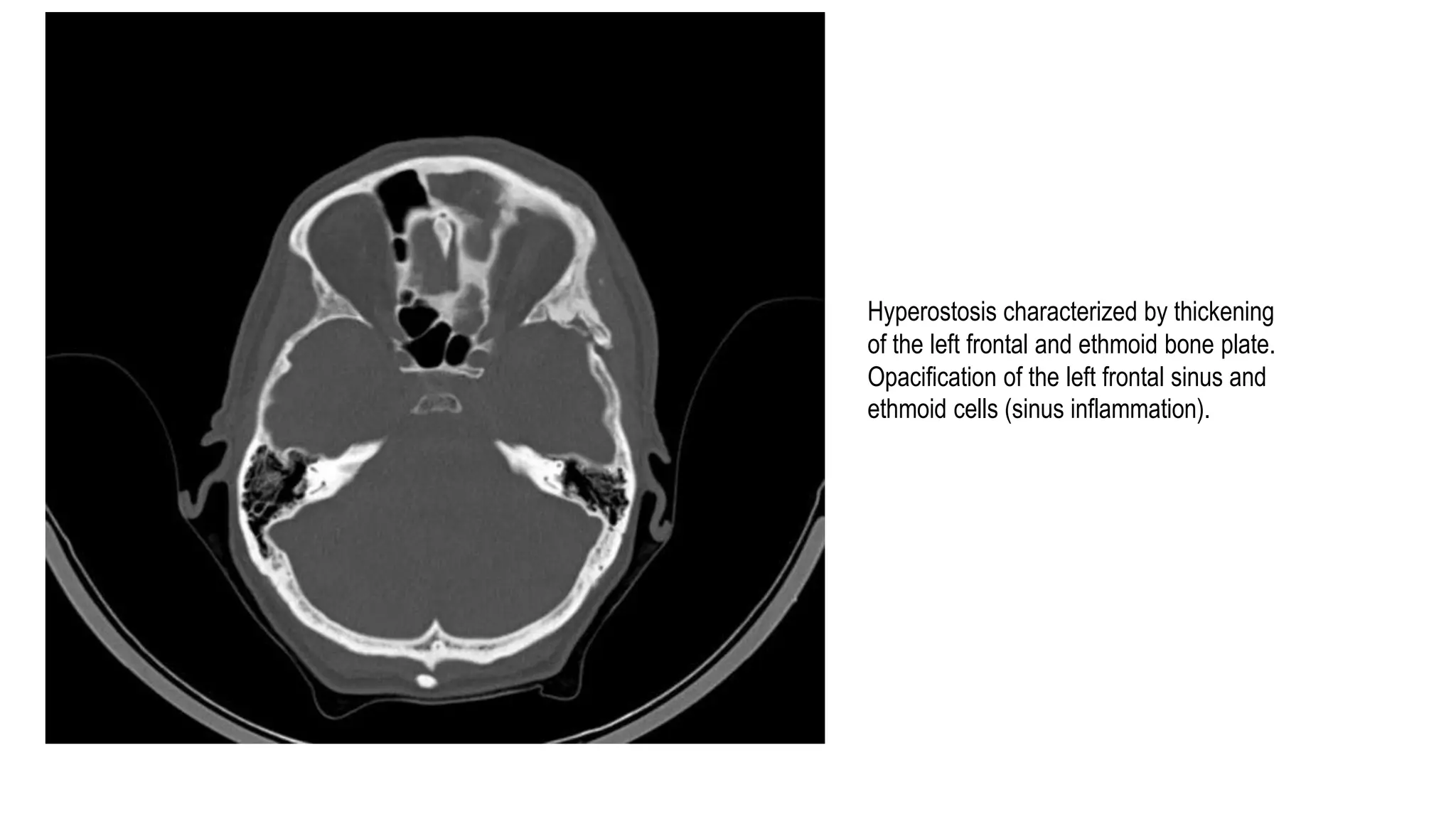 PNS INFLAMMATION.pptx