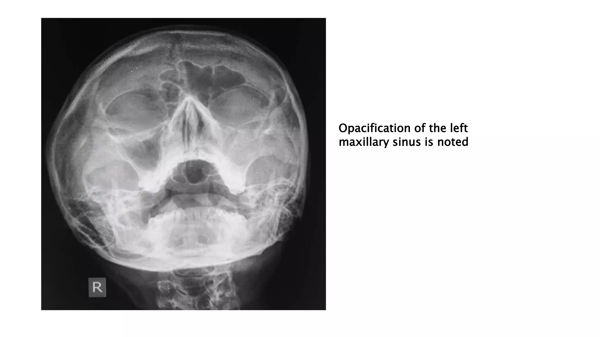 PNS INFLAMMATION.pptx