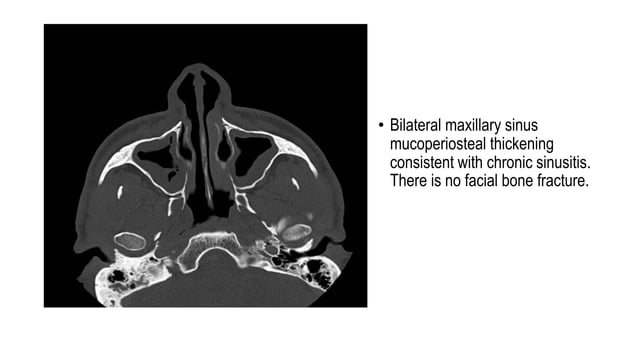 PNS INFLAMMATION.pptx