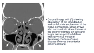 PNS INFLAMMATION.pptx