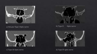 Radiological approach to PNS (Paranasal sinus) Masses | PPTX