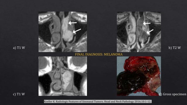 Radiological approach to PNS (Paranasal sinus) Masses | PPTX