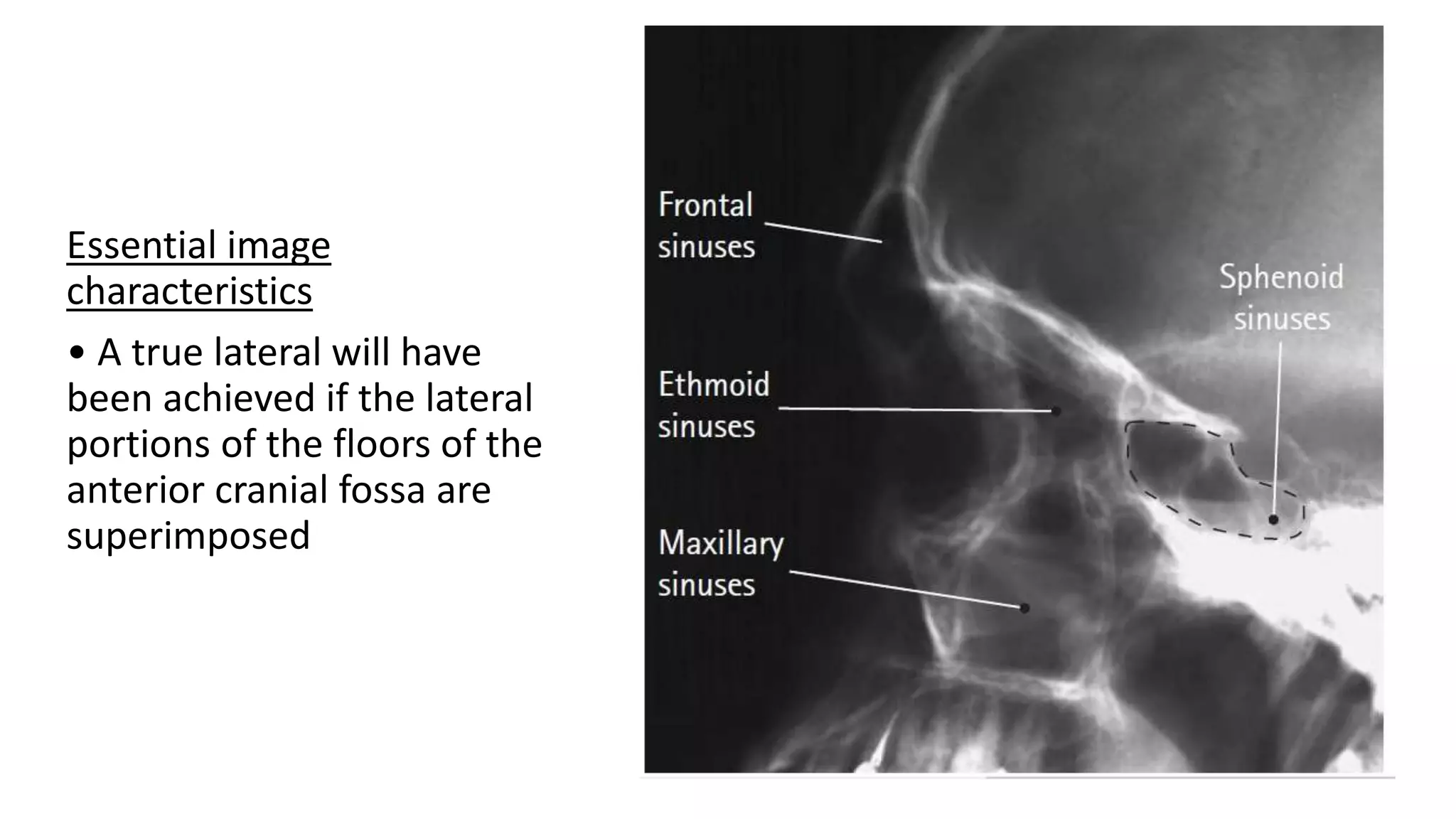 Anatomy and Xray of PNS and orbit | PPTX