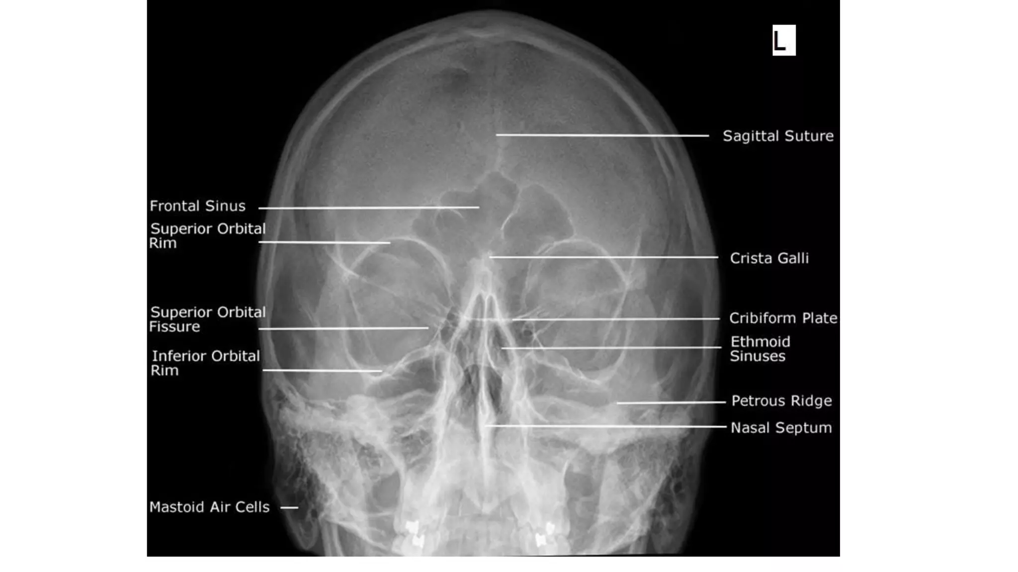 Anatomy and Xray of PNS and orbit | PPTX