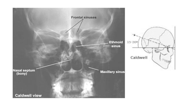 Anatomy and Xray of PNS and orbit | PPTX