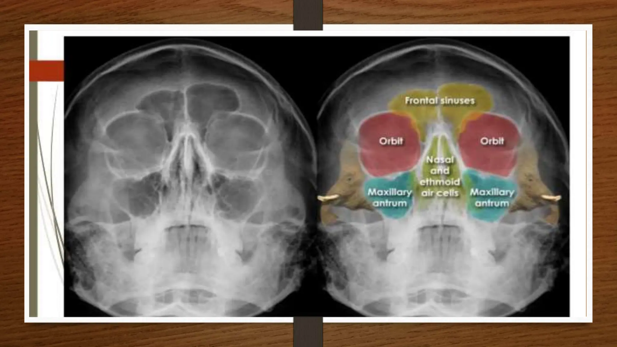 PNS , Orbit and Neck .pptx