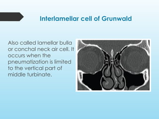 Paranasal Sinuses: Radiological Anatomy and Variants | PPTX