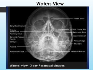Paranasal Sinuses: Radiological Anatomy and Variants | PPTX
