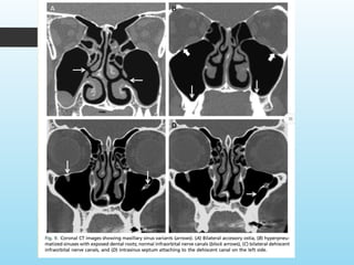 Paranasal Sinuses: Radiological Anatomy and Variants | PPTX