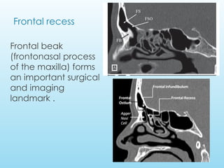 Paranasal Sinuses: Radiological Anatomy and Variants | PPTX