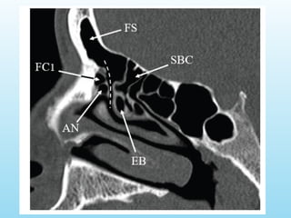 Paranasal Sinuses: Radiological Anatomy and Variants | PPTX