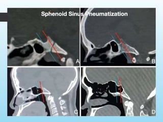 Paranasal Sinuses: Radiological Anatomy and Variants | PPTX