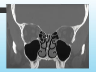 Paranasal Sinuses: Radiological Anatomy and Variants | PPTX
