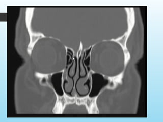 Paranasal Sinuses: Radiological Anatomy and Variants | PPTX