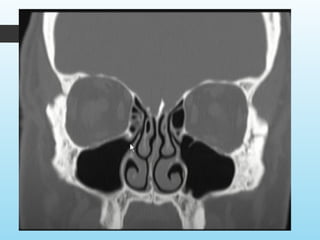 Paranasal Sinuses: Radiological Anatomy and Variants | PPTX
