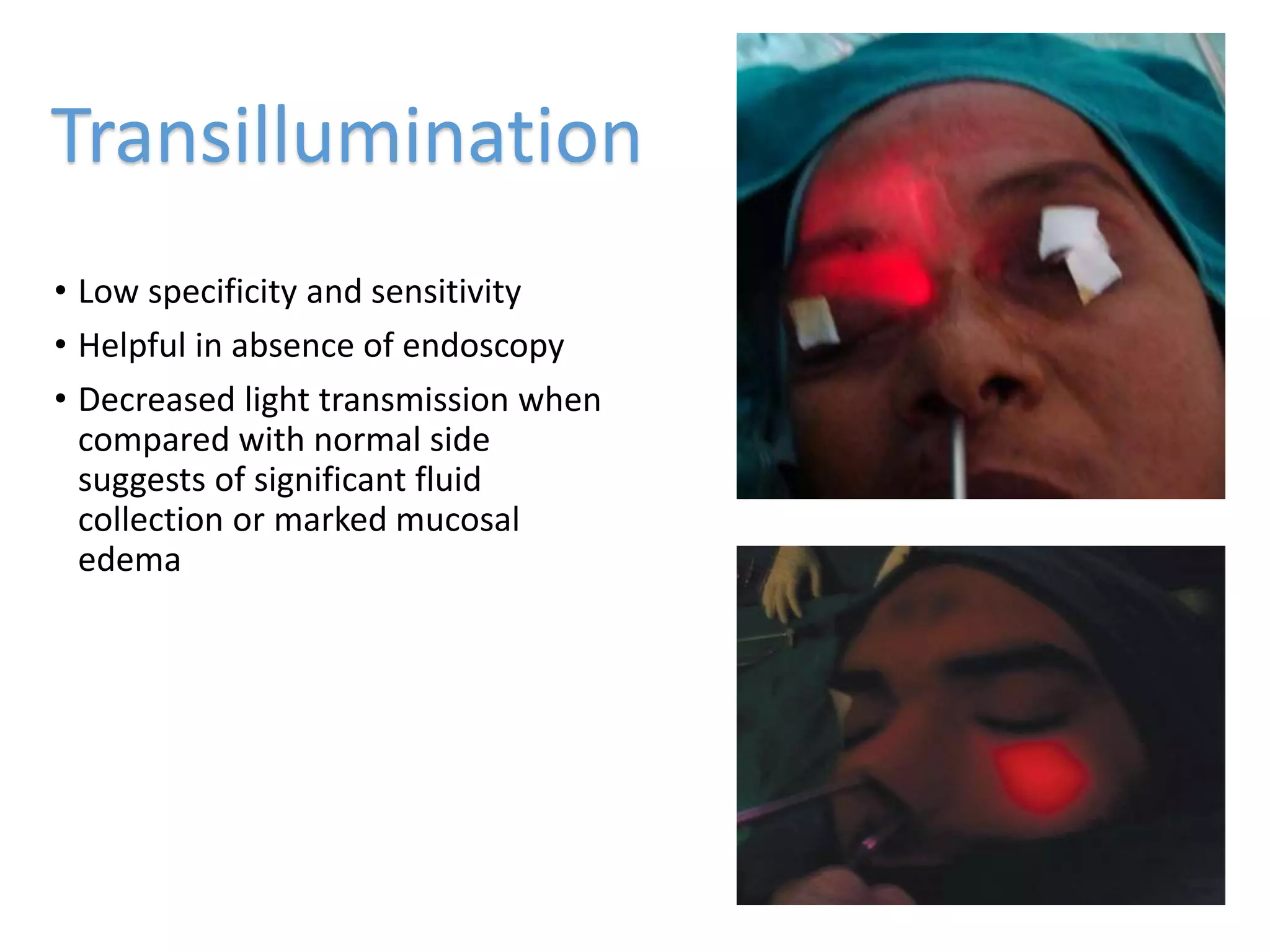 Paranasal sinus diseases and their management | PPTX