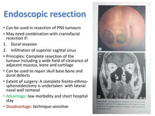 Paranasal sinus diseases and their management | PPTX