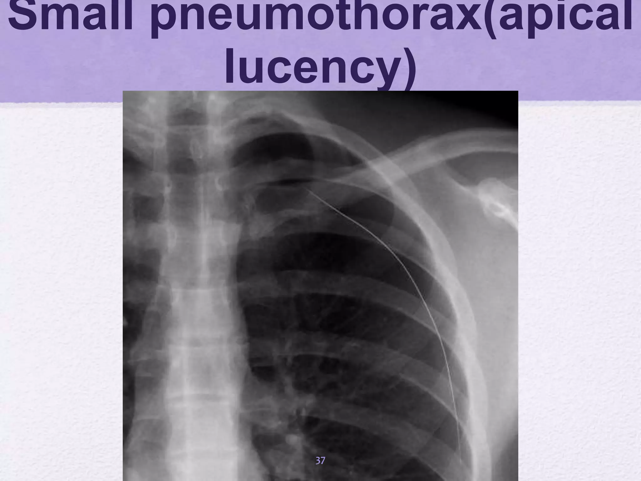 Pnuemothorax- peri-operative case | PPTX