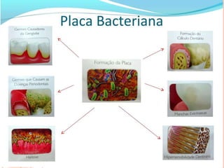 Placa_Bacteriana_ou_Biofilme_Dental.pptx