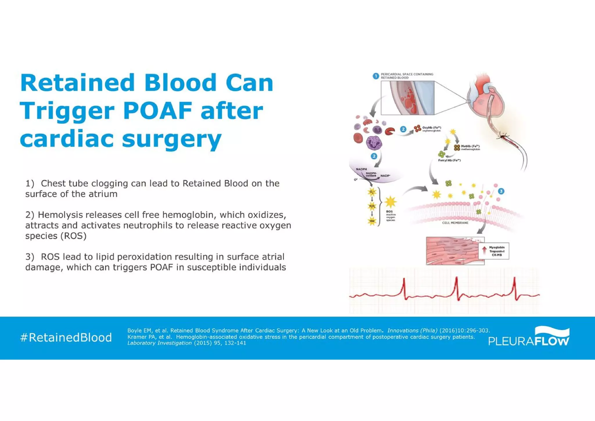 6. Retained Blood Can Trigger POAF After Cardiac Surgery | PDF