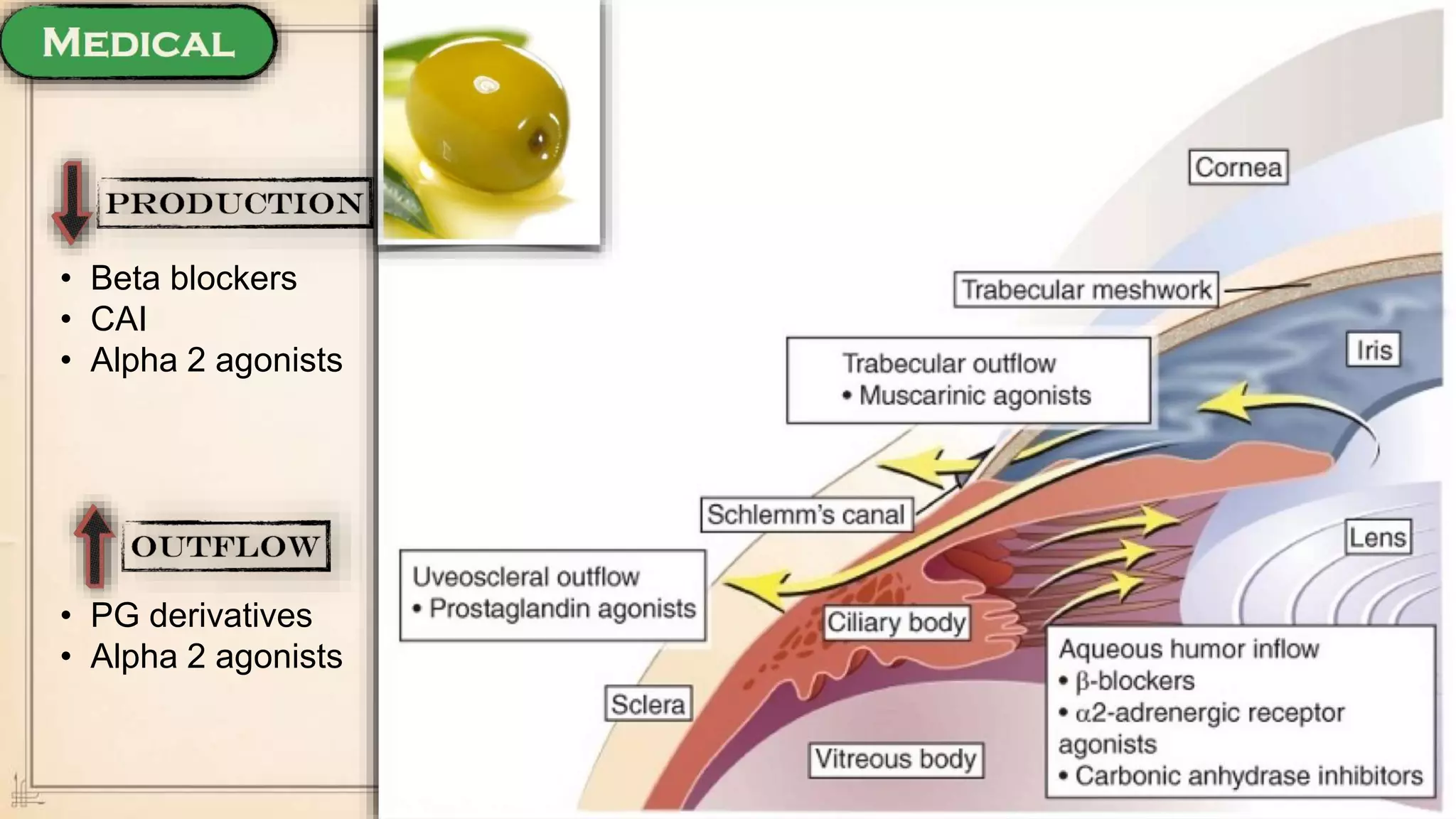 Primary open angle glaucoma | PPTX