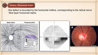 Primary open angle glaucoma | PPTX