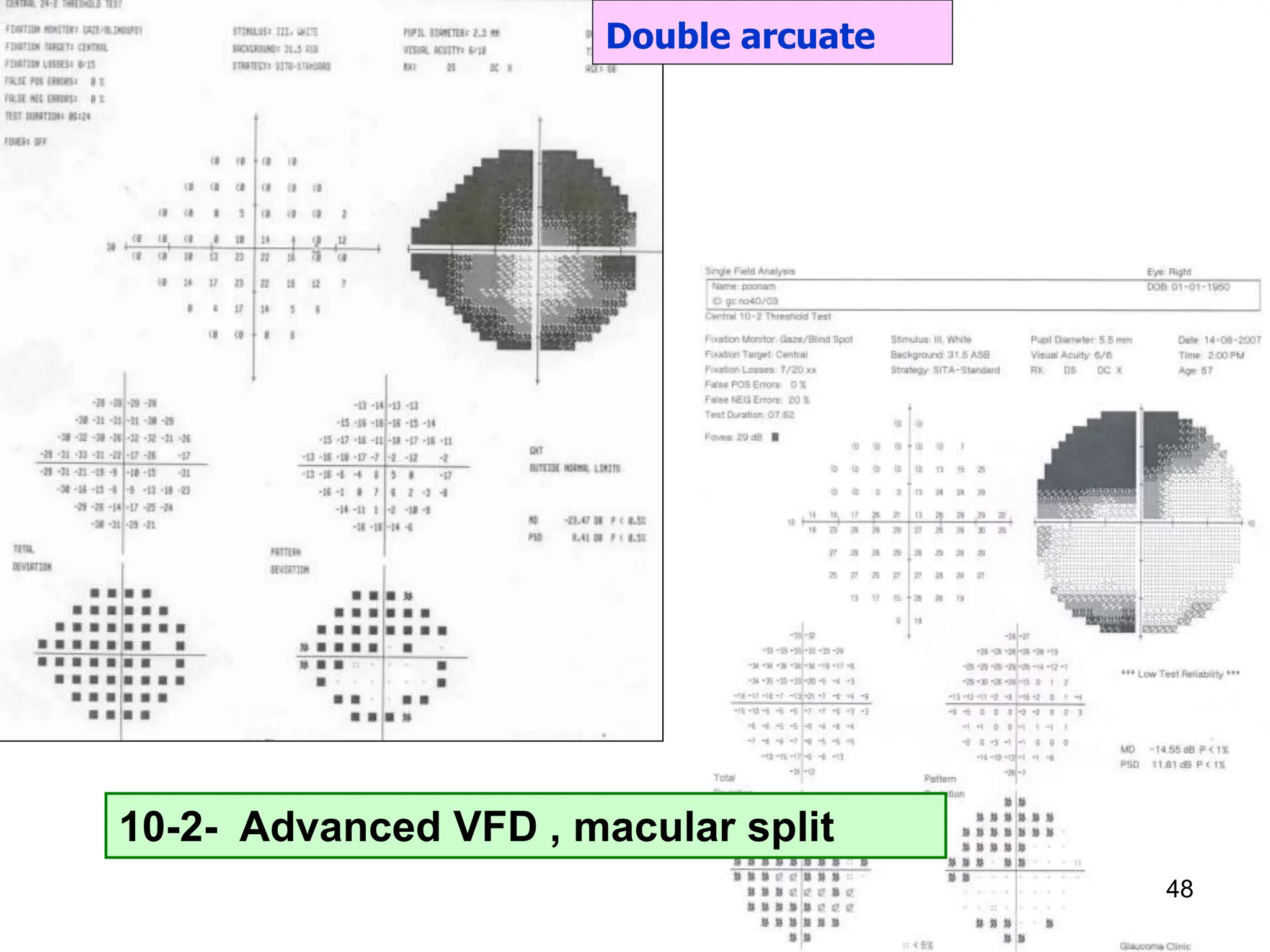 Primary open angle glaucoma presentation | PPT