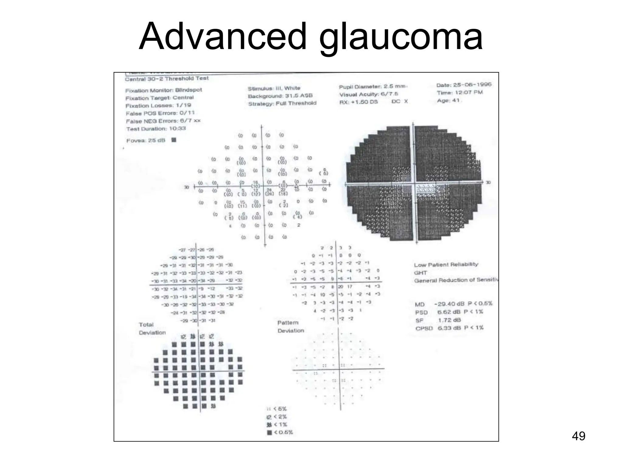 Primary open angle glaucoma presentation | PPT